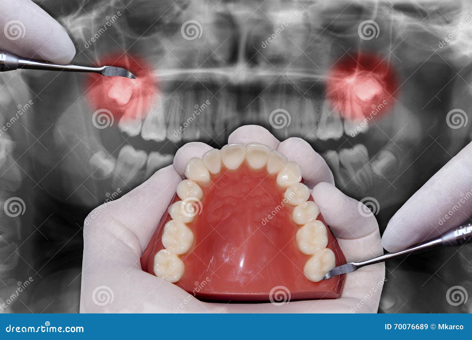 1,613 Teeth Removal Stock Photos - Free & Royalty-Free Stock Photos ...