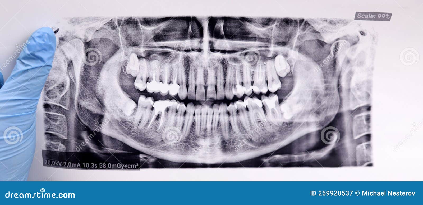 Dentist Points Finger at Wisdom Tooth at Panoramic Dental Tooth X-ray ...