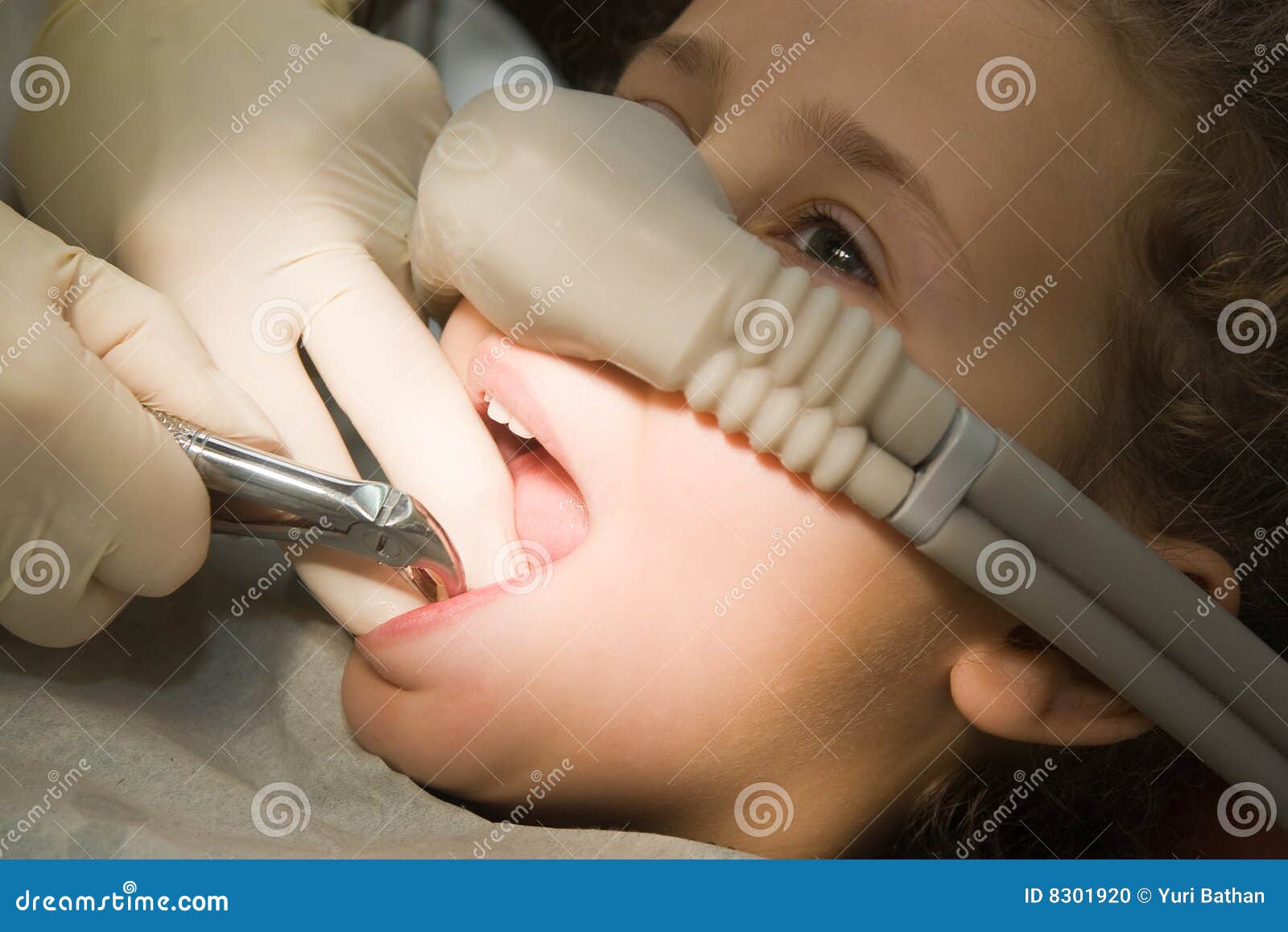 Dentist Pulling Tooth With Forceps Out Of Jaw Model. Teeth Extraction ...