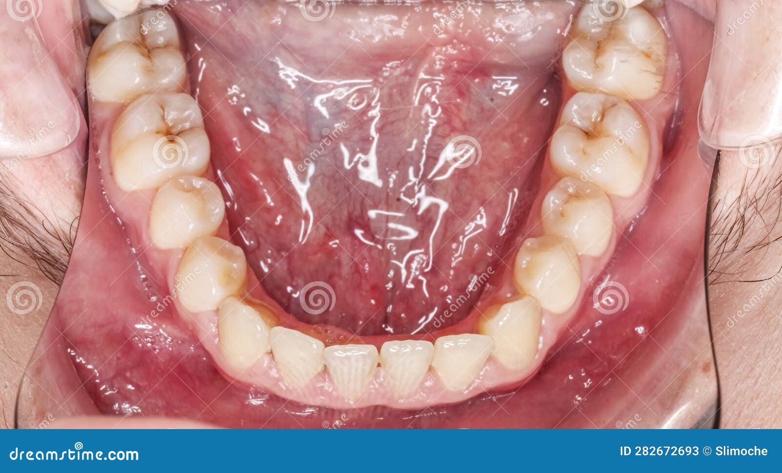 Dentistry Case of Lower Mandibular Arch. Stock Image - Image of ...