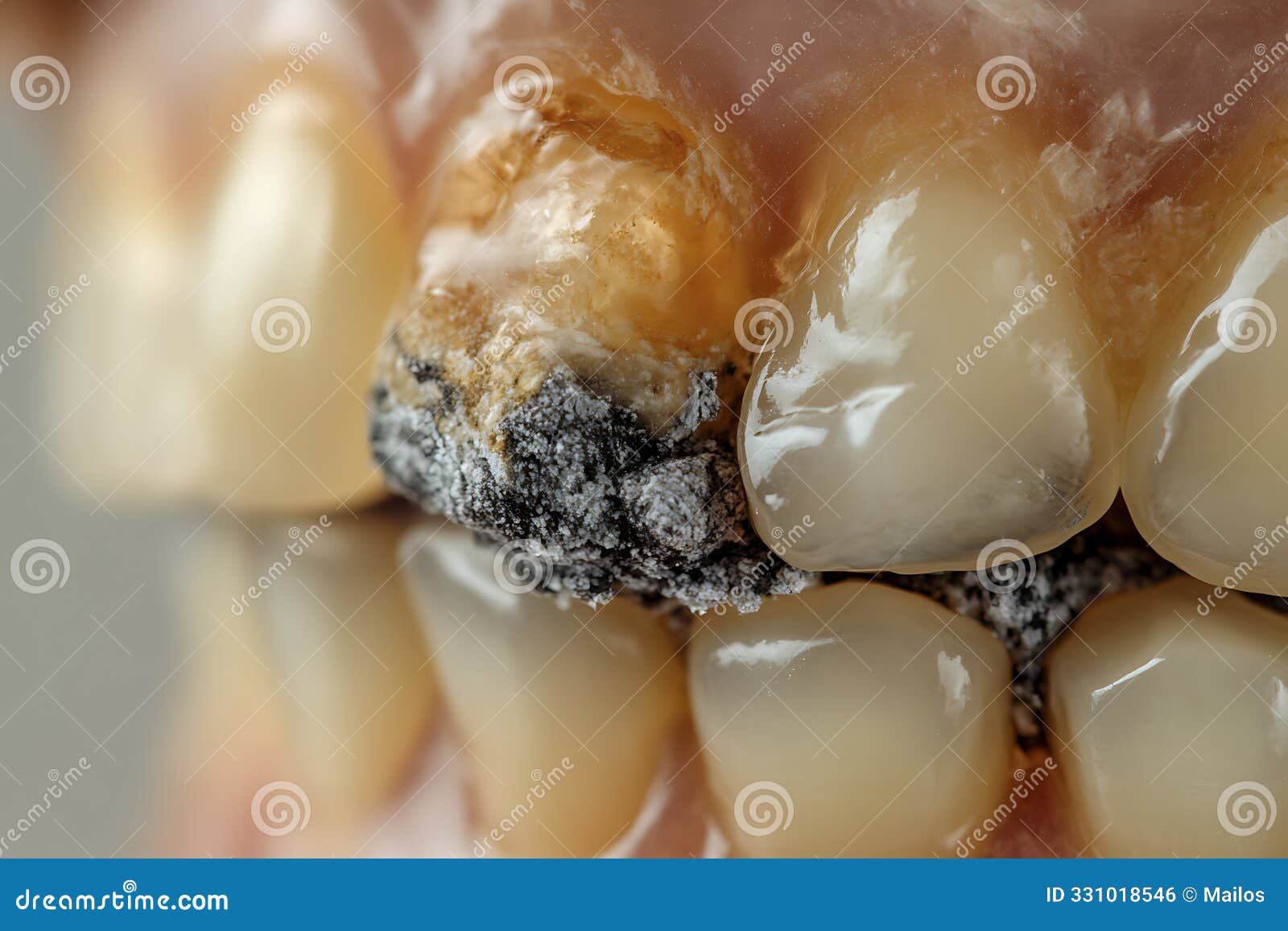 Dentistry Focus: Plaque Formation on Tooth Stone Surface Stock Photo ...