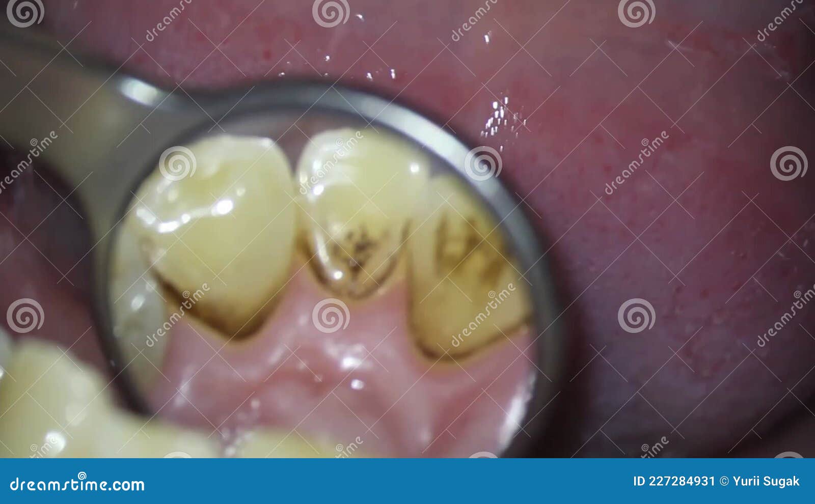 Dentistry, Scanning with a Microscope, Examination of the Inner Surface ...