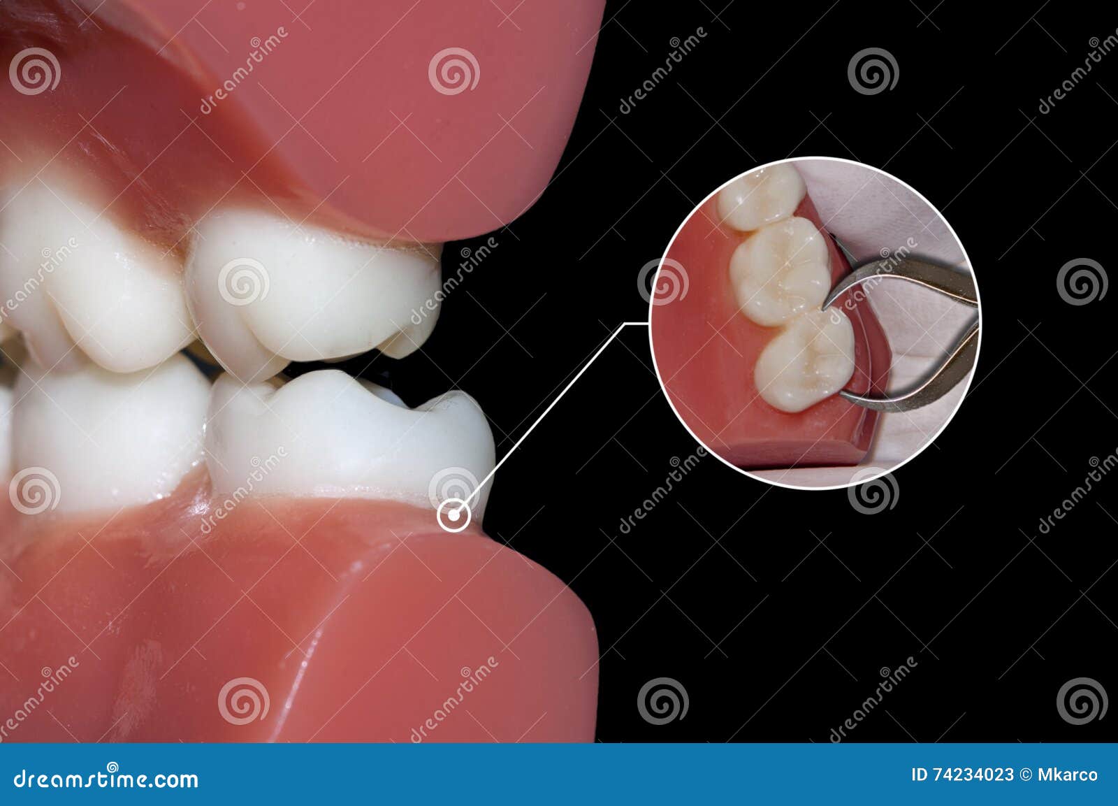 Molar Extraction. Tooth Loss Anatomical Structure. 3d Medical ...