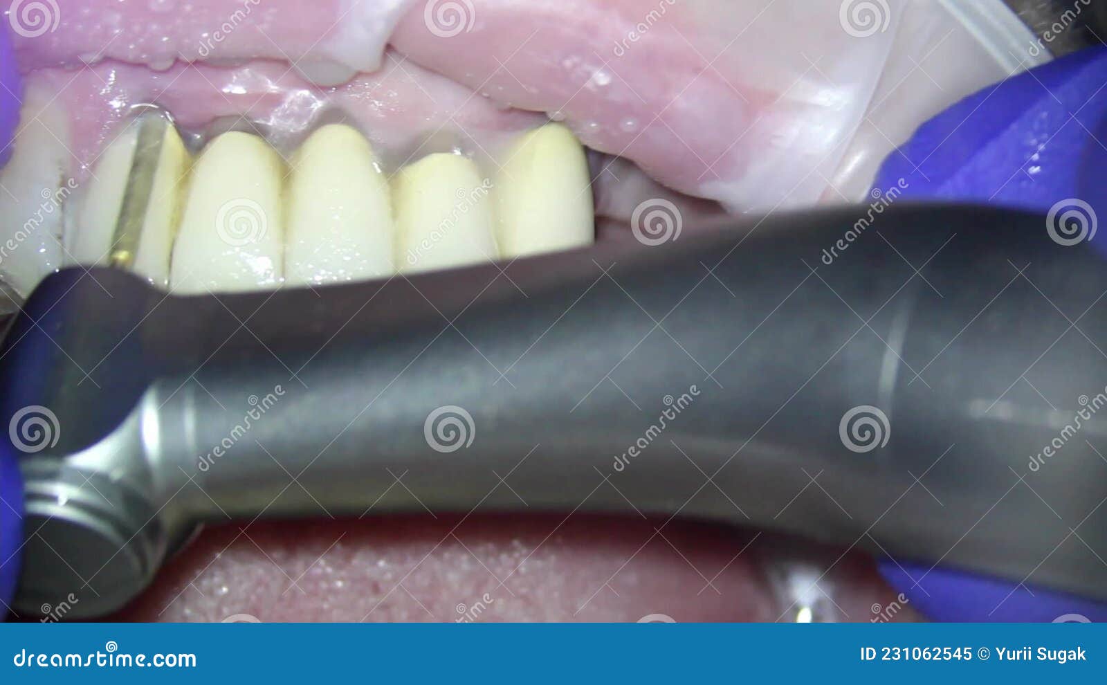 Dentistry. Video Filming Under a Microscope Stock Video - Video of ...