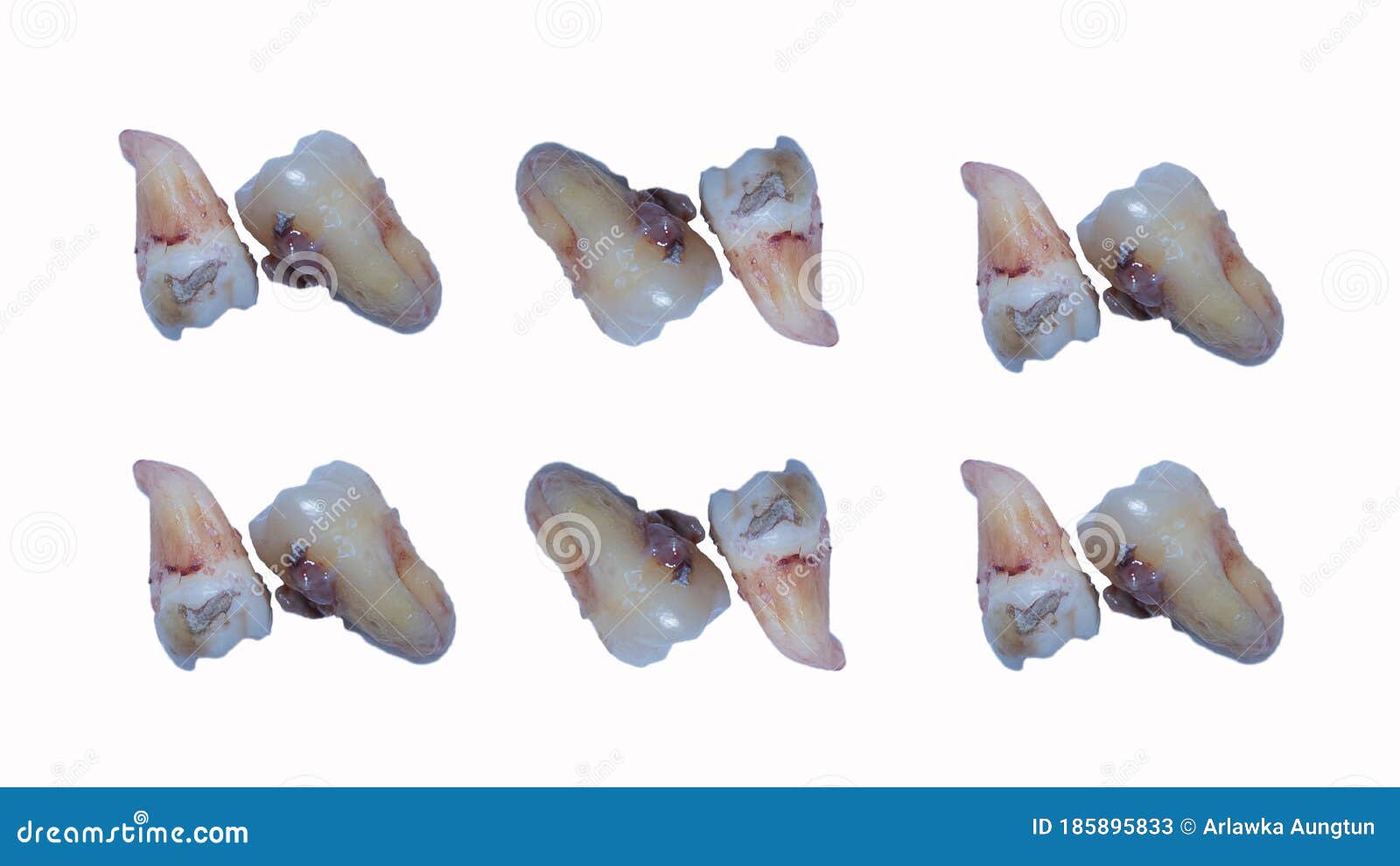 Dentistry, Wisdom Teeth, Plucked Out, Placed on a White Stock Image ...