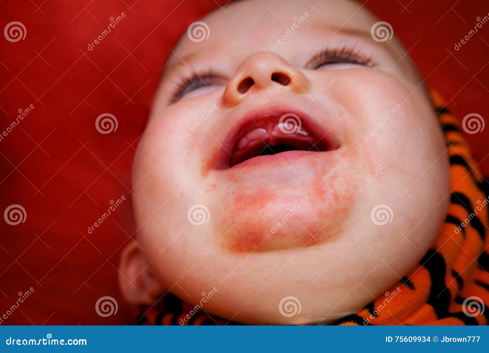 Dentitions-Baby Mit Geifer-Hautausschlag Stockfoto - Bild von feld ...