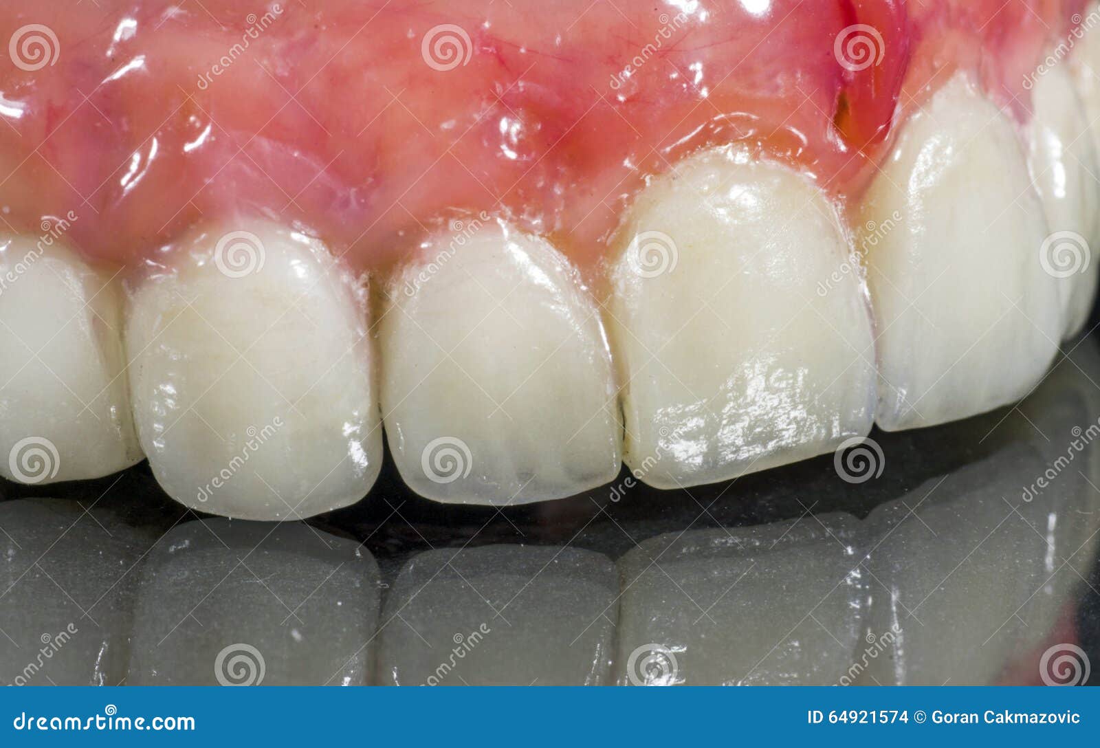 Denture Dental Implants Gypsum Print White Plaster Teeth In Dental ...