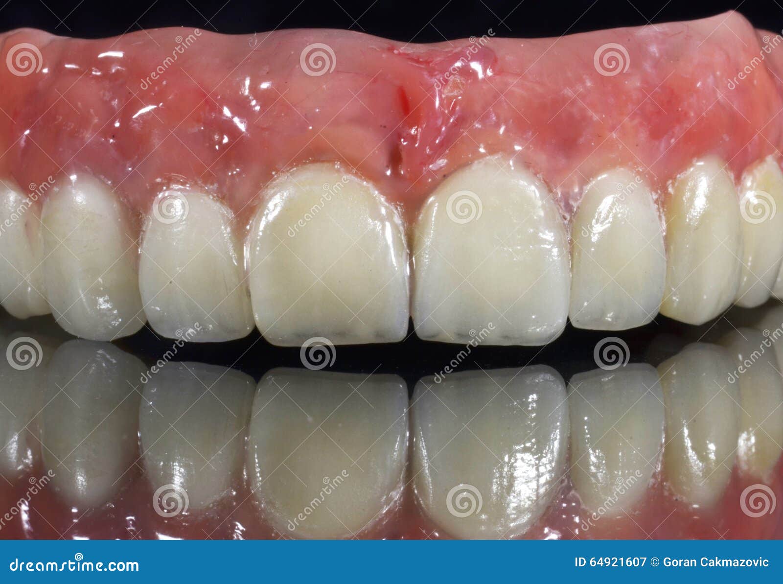 Denture Dental Implants Gypsum Print White Plaster Teeth In Dental ...