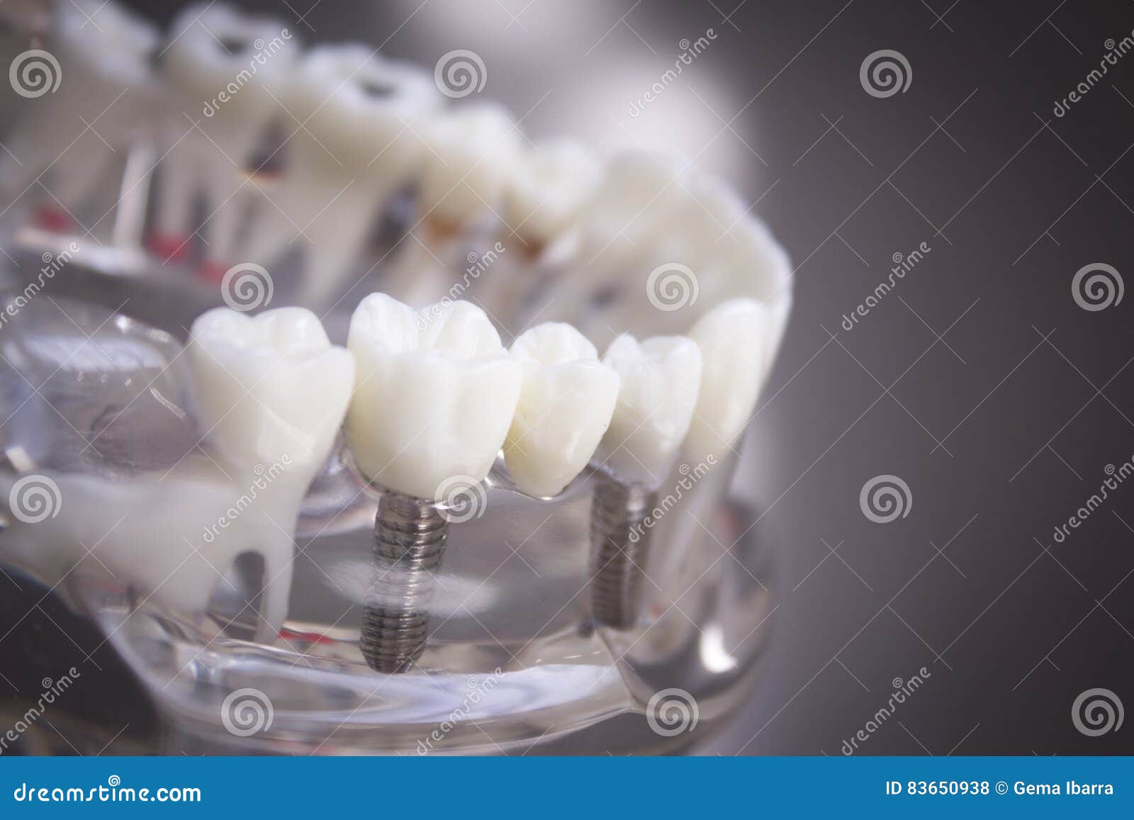 Denture for Students Transparent Stock Photo - Image of close, white ...