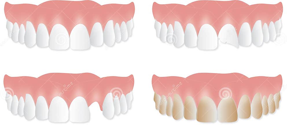 Denture Upper Plate. Broken, Chipped, Stained Teeth Stock Vector ...