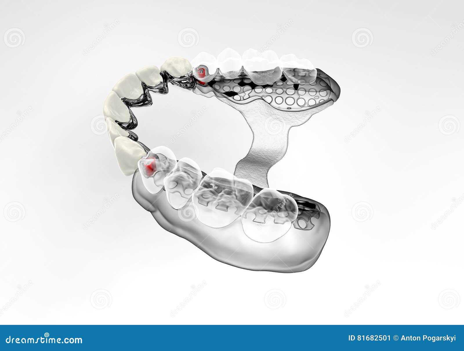 Dentures stock illustration. Illustration of implantology - 81682501