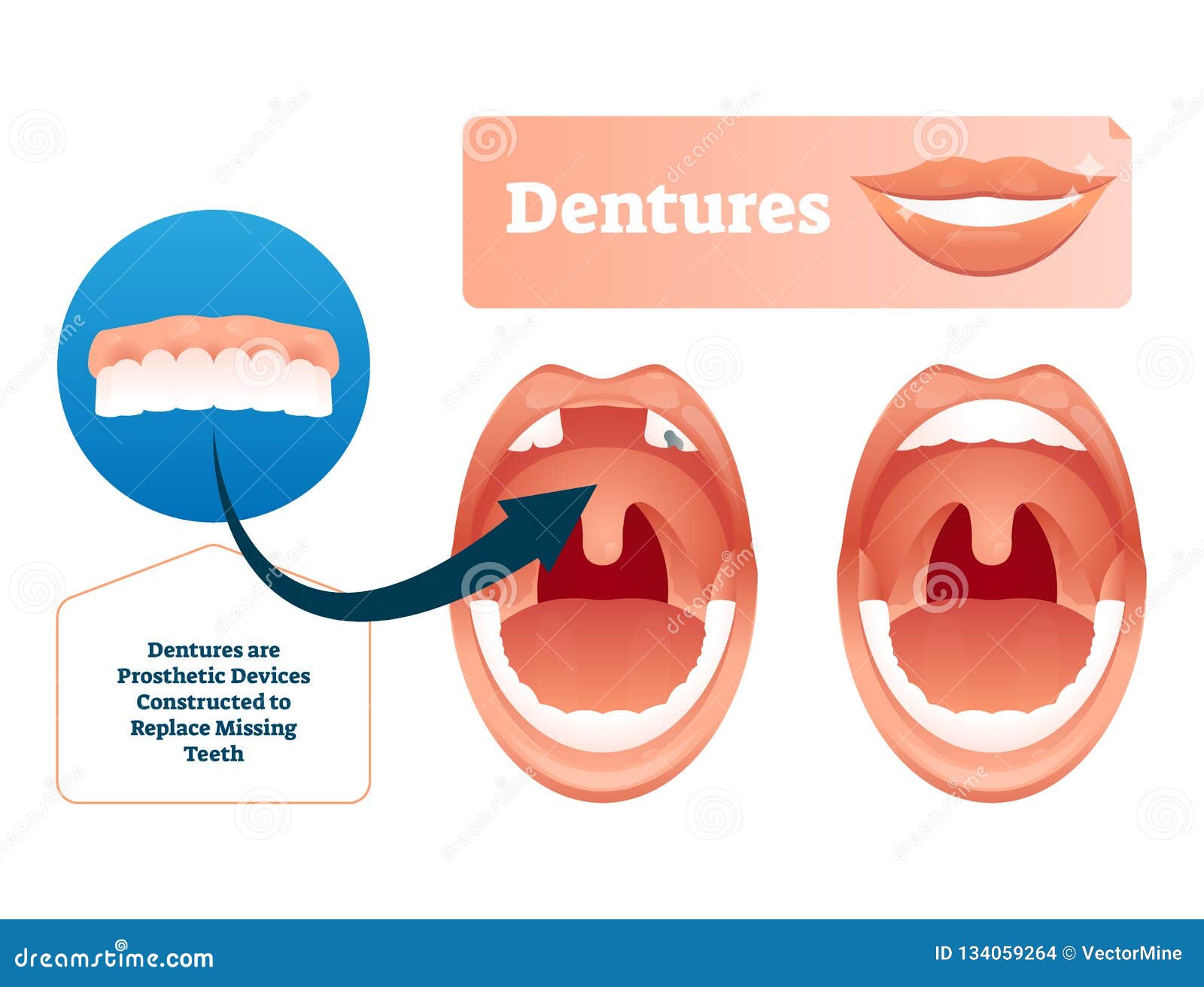 Oral, Mouth Ulcers, Canker Sores, Internal Organs Anatomy Body Part ...
