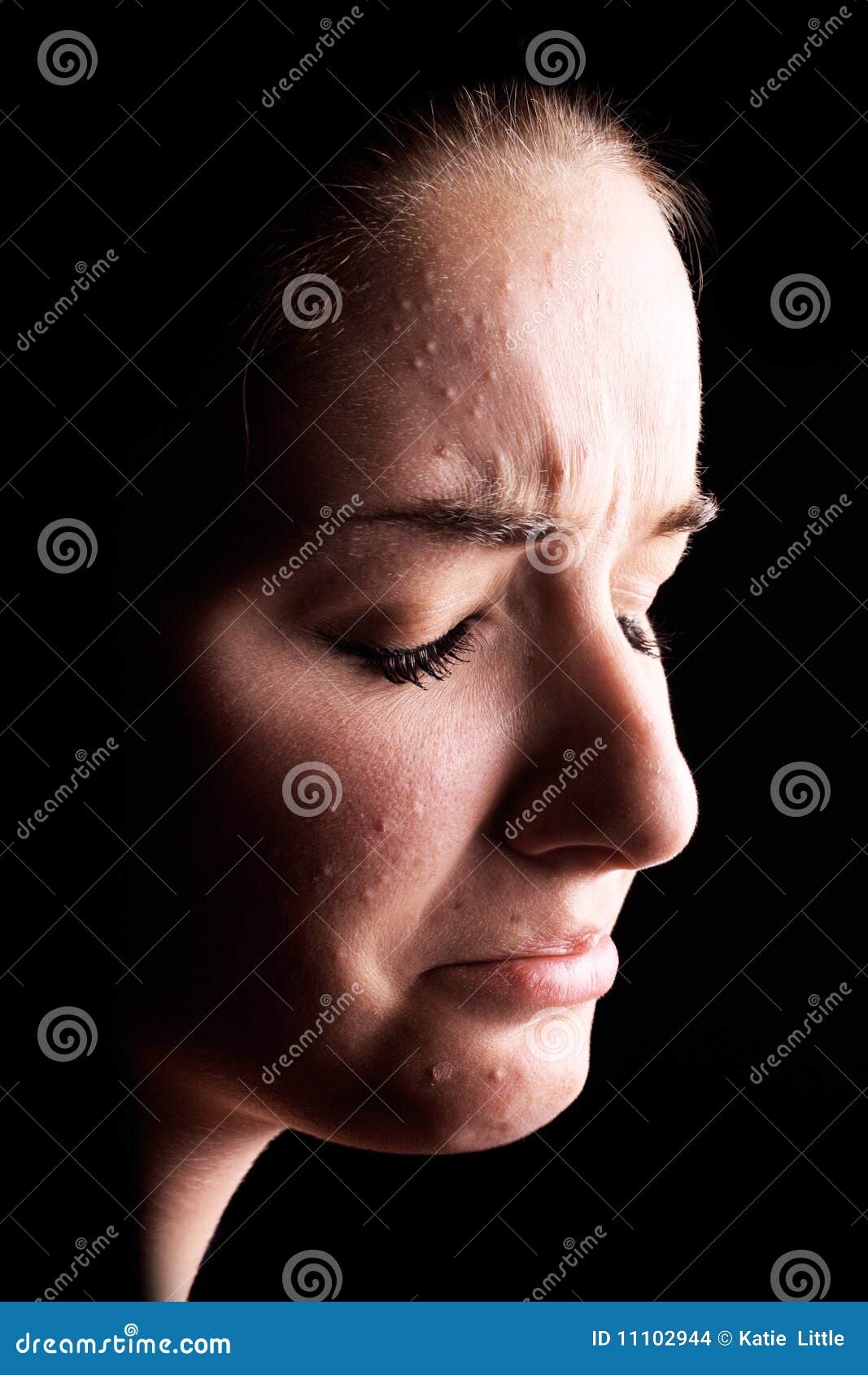Depressed Female Acne Sufferer Stock Photo - Image of cheek, esteem ...