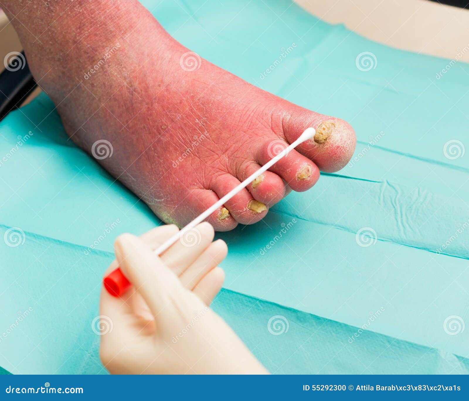 An Der Dermatologie Mit Chronischer Mykose Stockfoto - Bild von ...