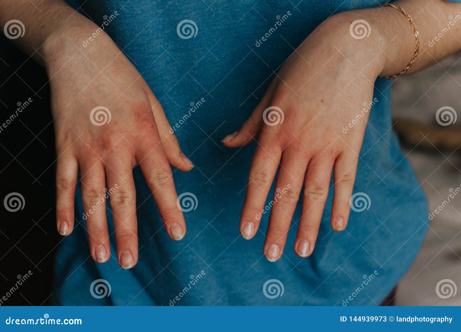 Derma Problem on Hands. Red Eczema Stock Image - Image of illness ...