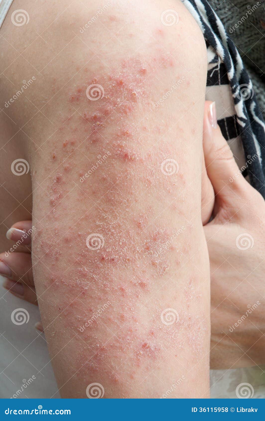 Dermatite Alérgica Do Prurido Foto de Stock - Imagem de espinha, eczema ...