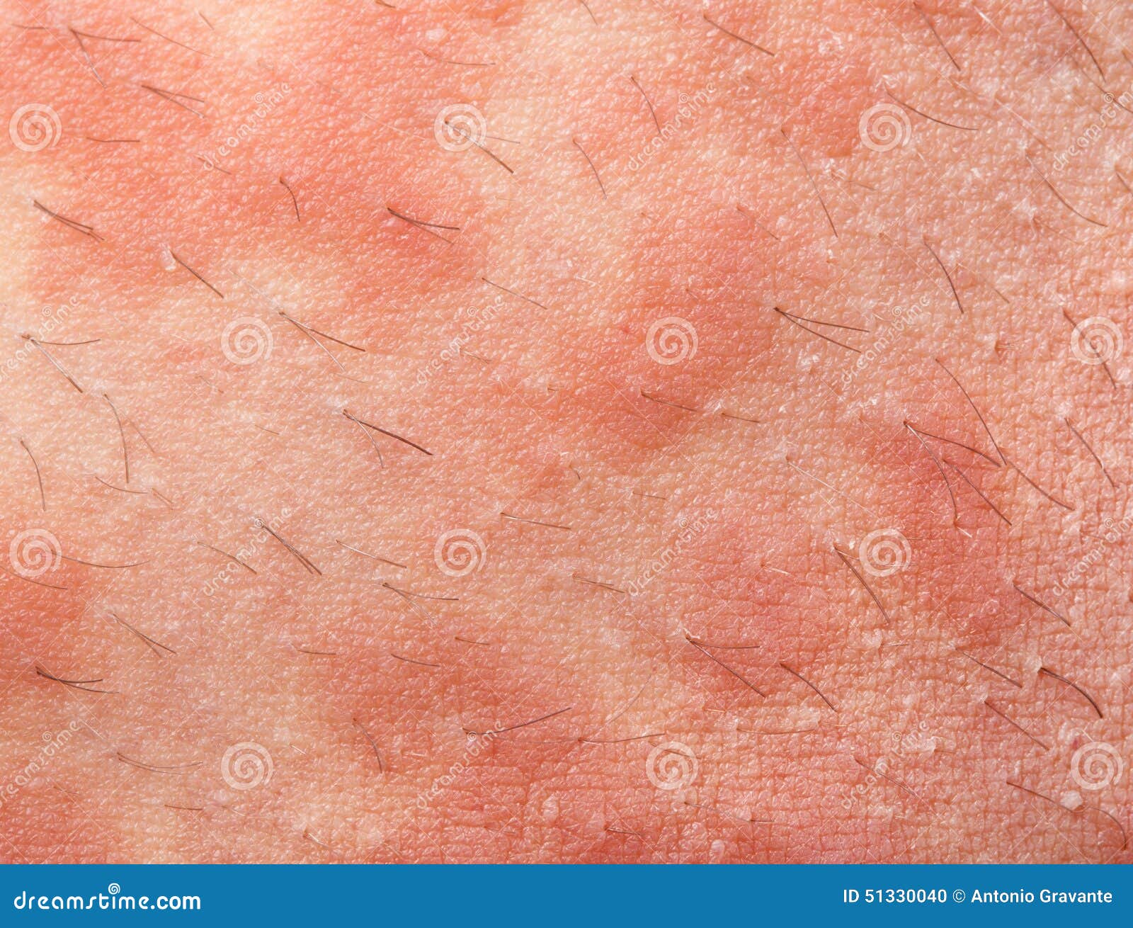 Dermatite Atópica Da Eczema Foto de Stock - Imagem de alergia ...