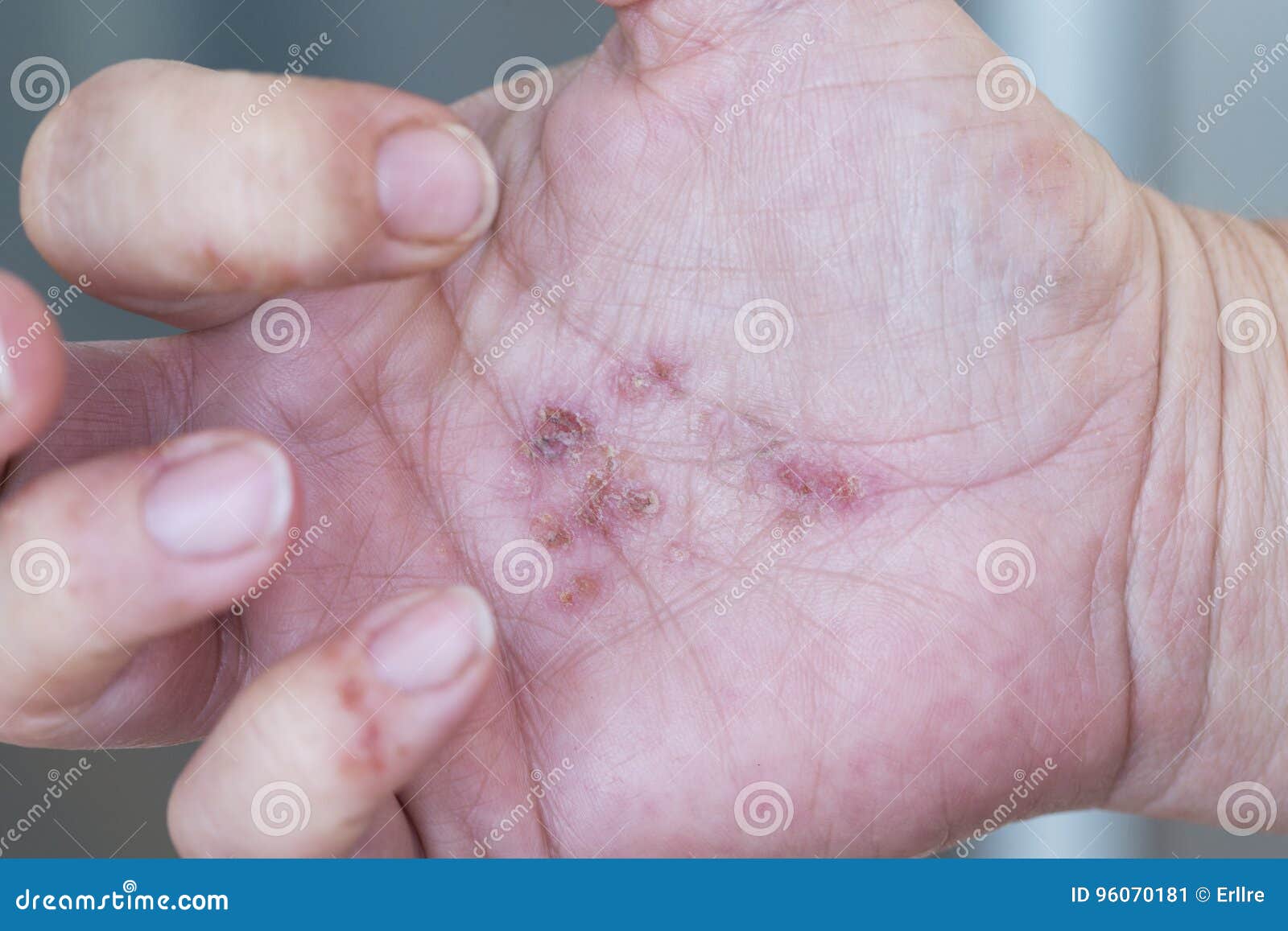 Dermatite dans des mains image stock. Image du fermer - 96070181