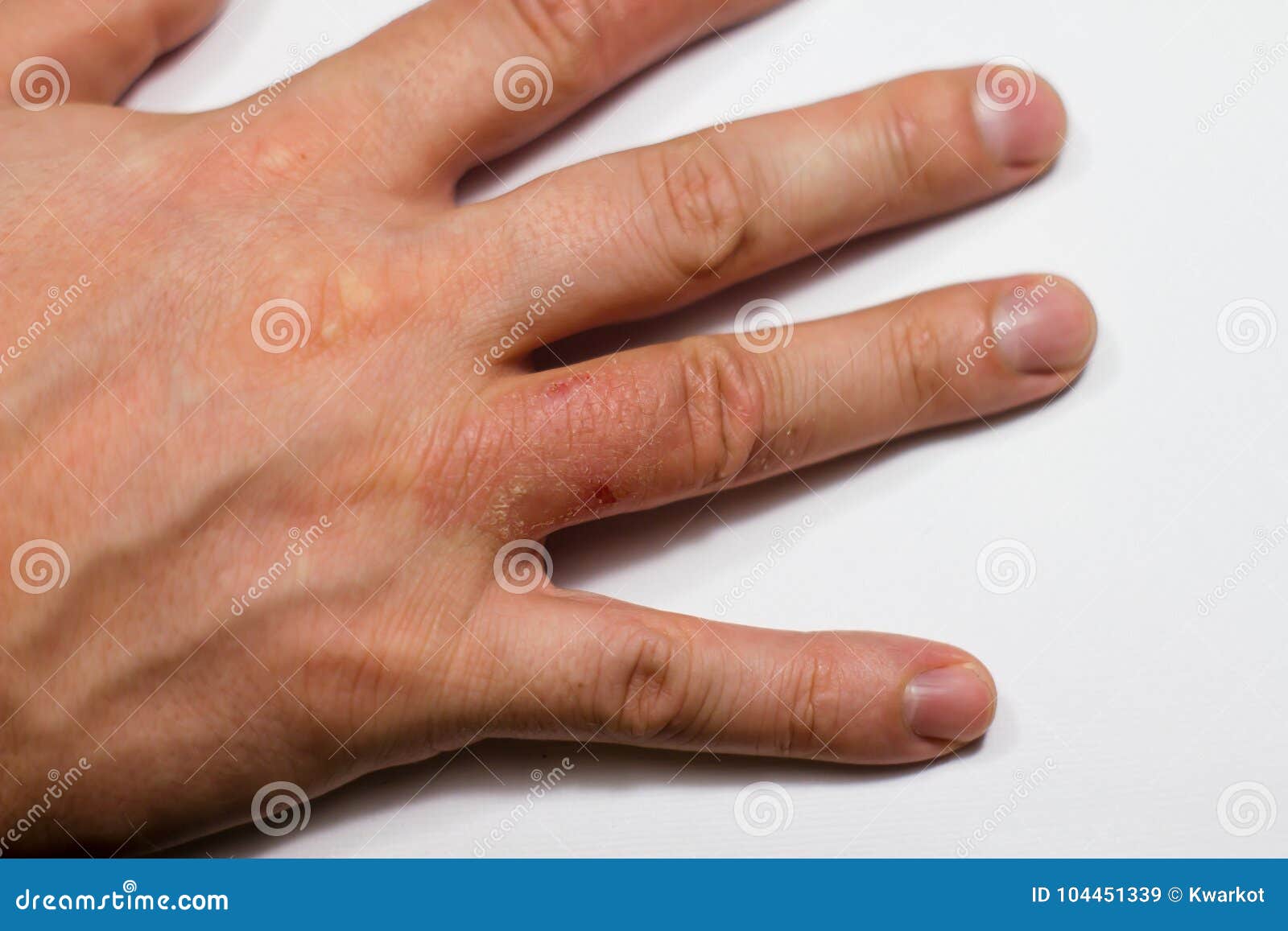 Dermatite De Main Eczema De Main Image stock - Image du douloureux ...