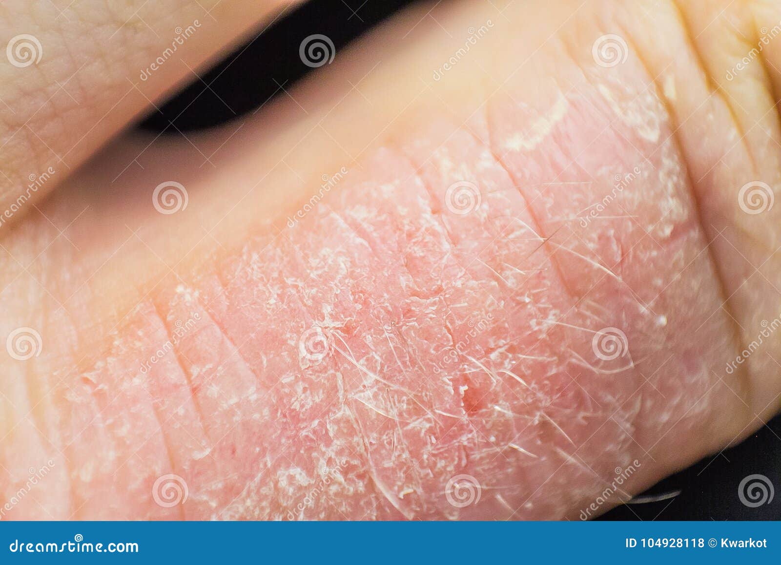 Dermatite De Main Eczema De Main Photo stock - Image du dermatologue ...