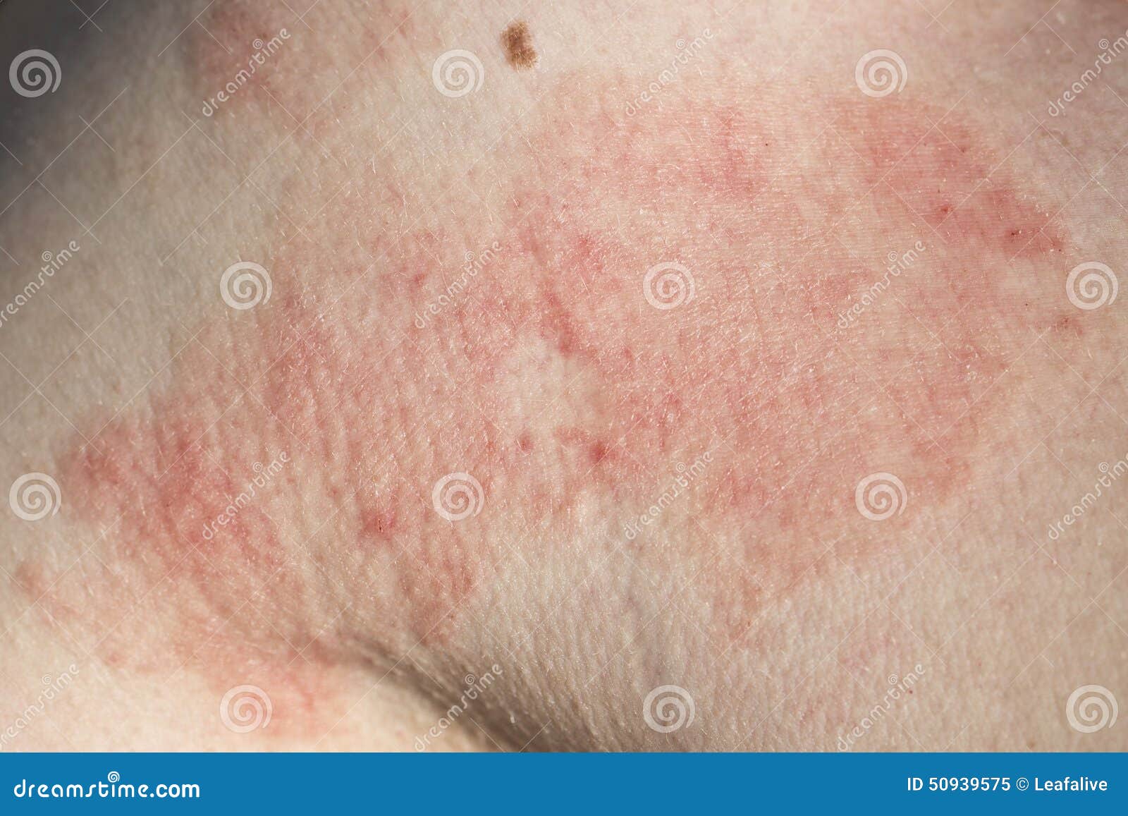 Dermatite de peau image stock. Image du allergique, dermatologie - 50939575