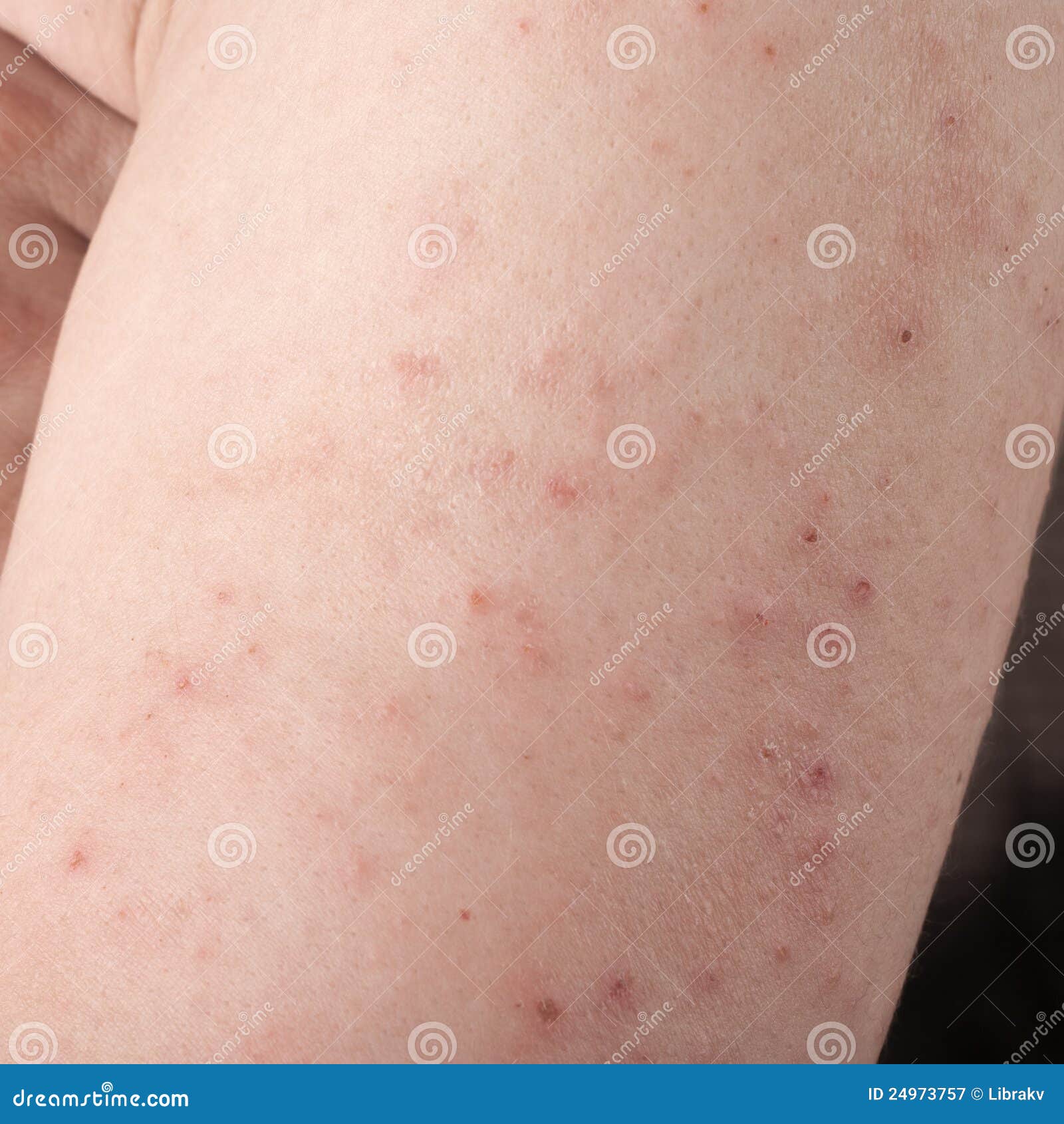 Dermatite Impétueuse Allergique Image stock - Image du infection, main ...