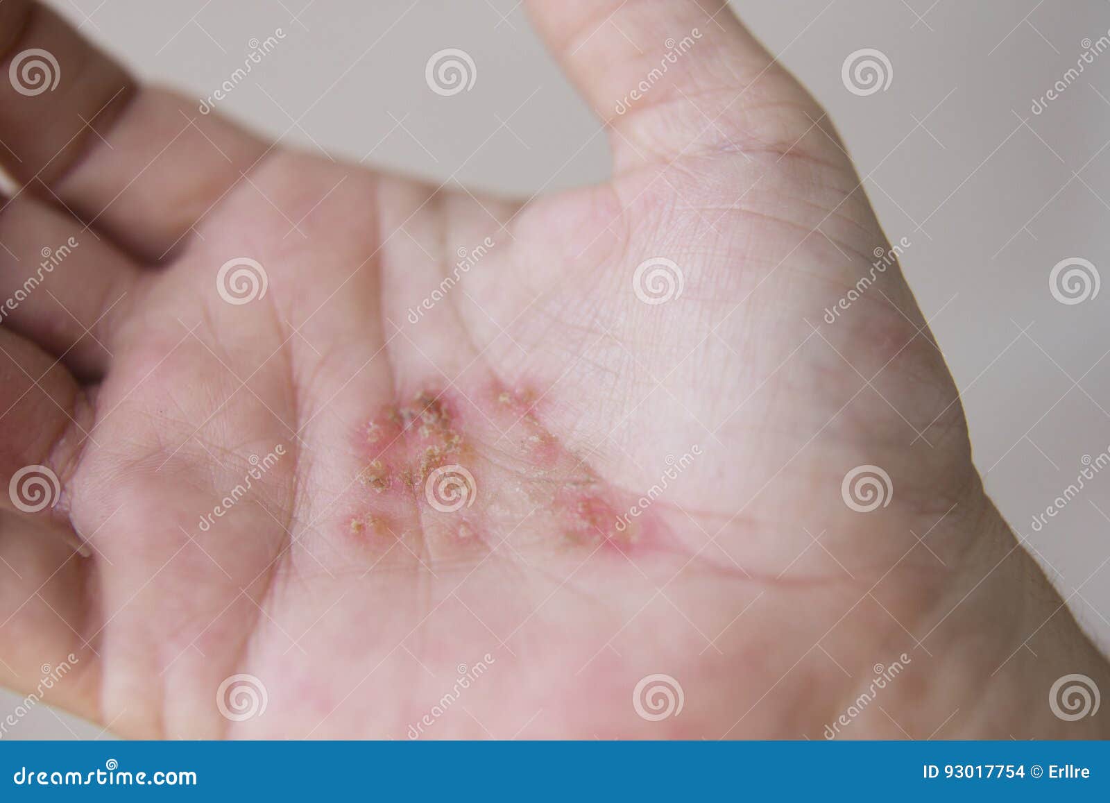 Dermatite in mani fotografia stock. Immagine di mano - 93017754