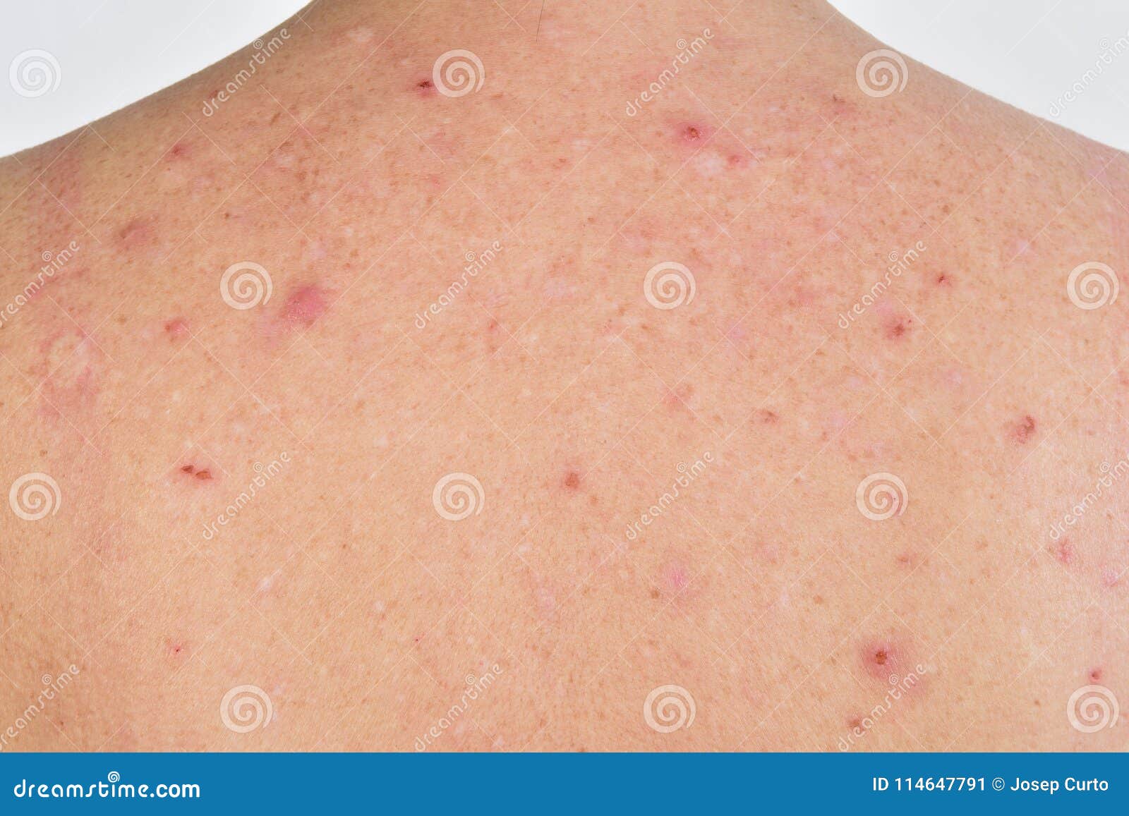 Dermatitis on the Back of a Stock Image - Image of healthcare, rash ...