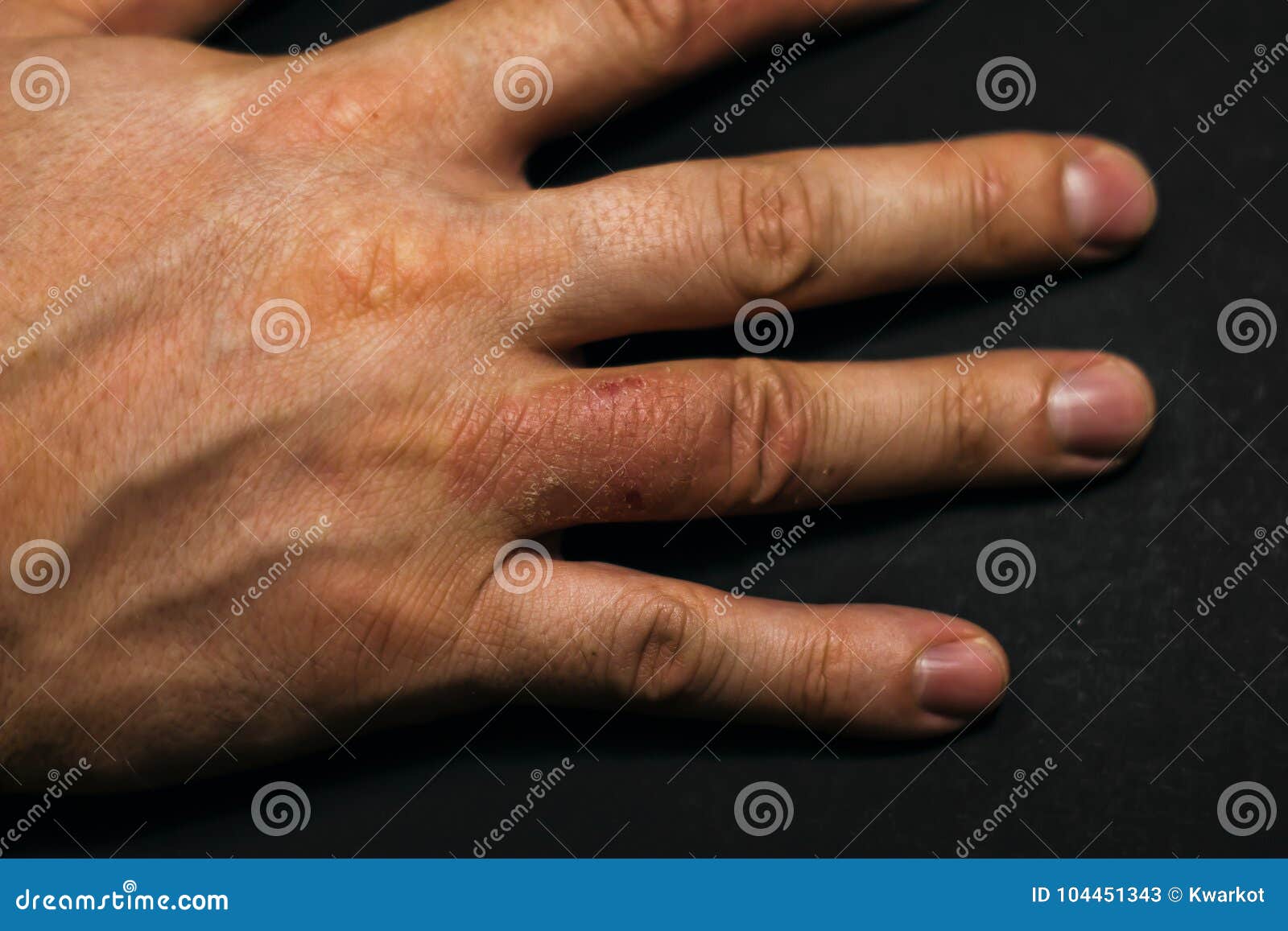 Dermatitis De La Mano Eczema De La Mano Imagen de archivo - Imagen de ...