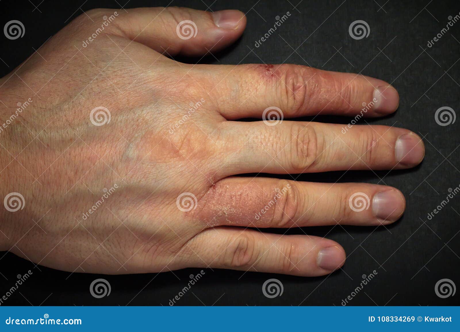 Dermatitis De La Mano Eczema De La Mano Imagen de archivo - Imagen de ...
