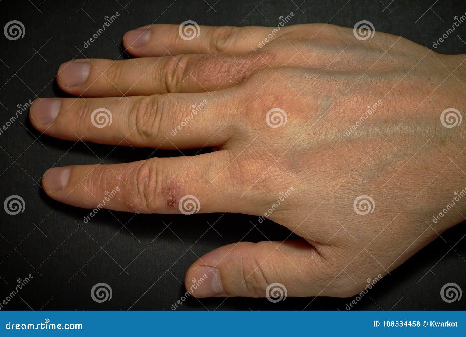 Dermatitis De La Mano Eczema De La Mano Foto de archivo - Imagen de ...