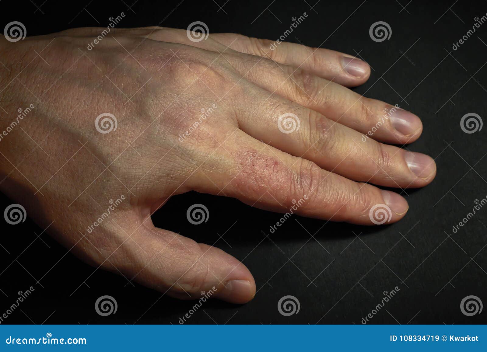 Dermatitis De La Mano Eczema De La Mano Imagen de archivo - Imagen de ...