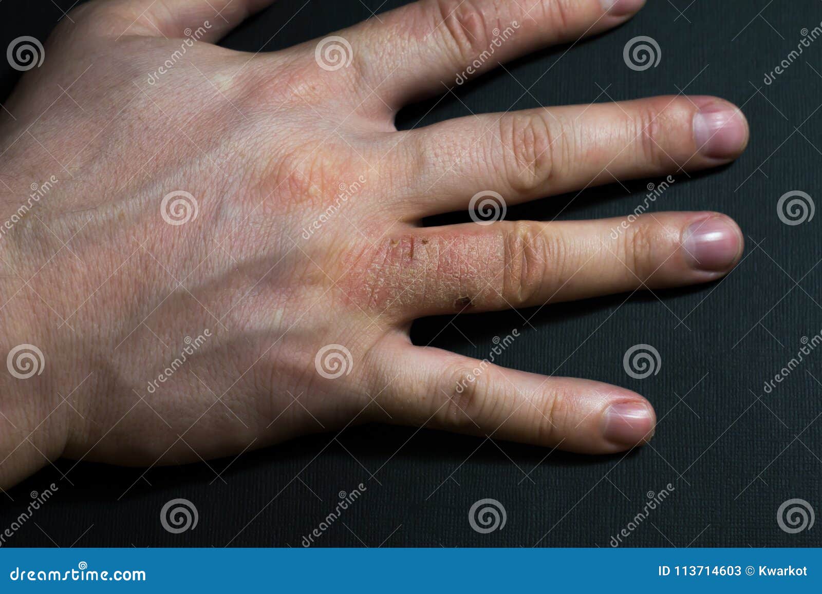Dermatitis De La Mano Eczema De La Mano Imagen de archivo - Imagen de ...
