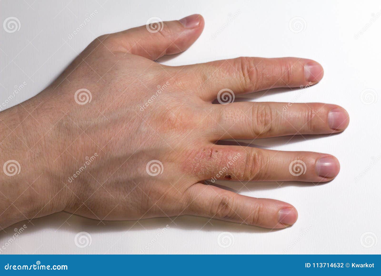 Dermatitis De La Mano Eczema De La Mano Foto de archivo - Imagen de ...