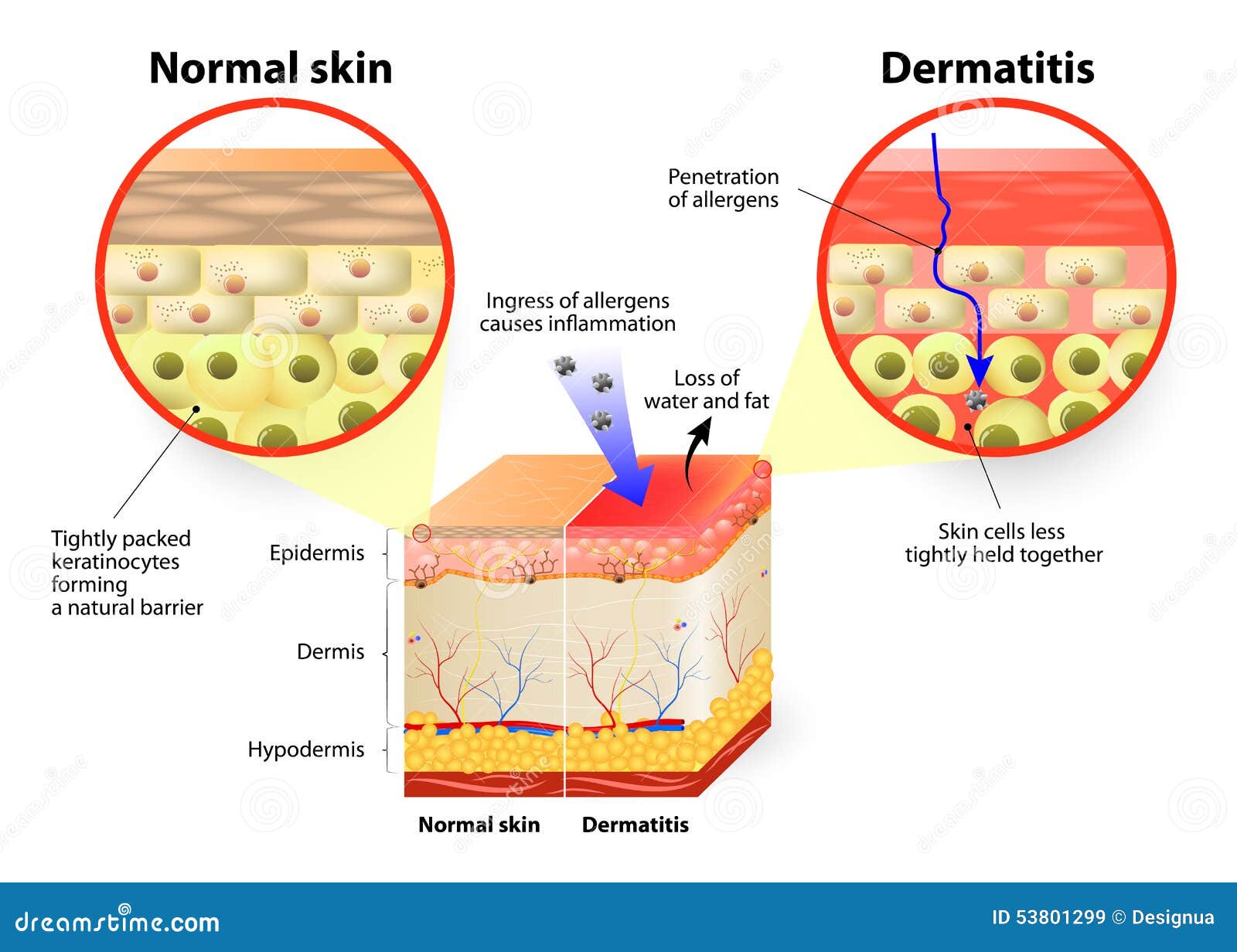 Atopic Dermatitis Eczema And Normal Skin Cell Illustration Healthy