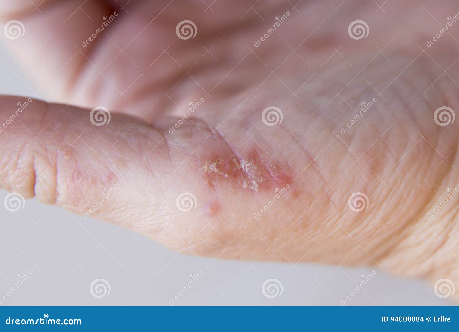 Dermatitis in hands stock photo. Image of skin, dermatology - 94000884