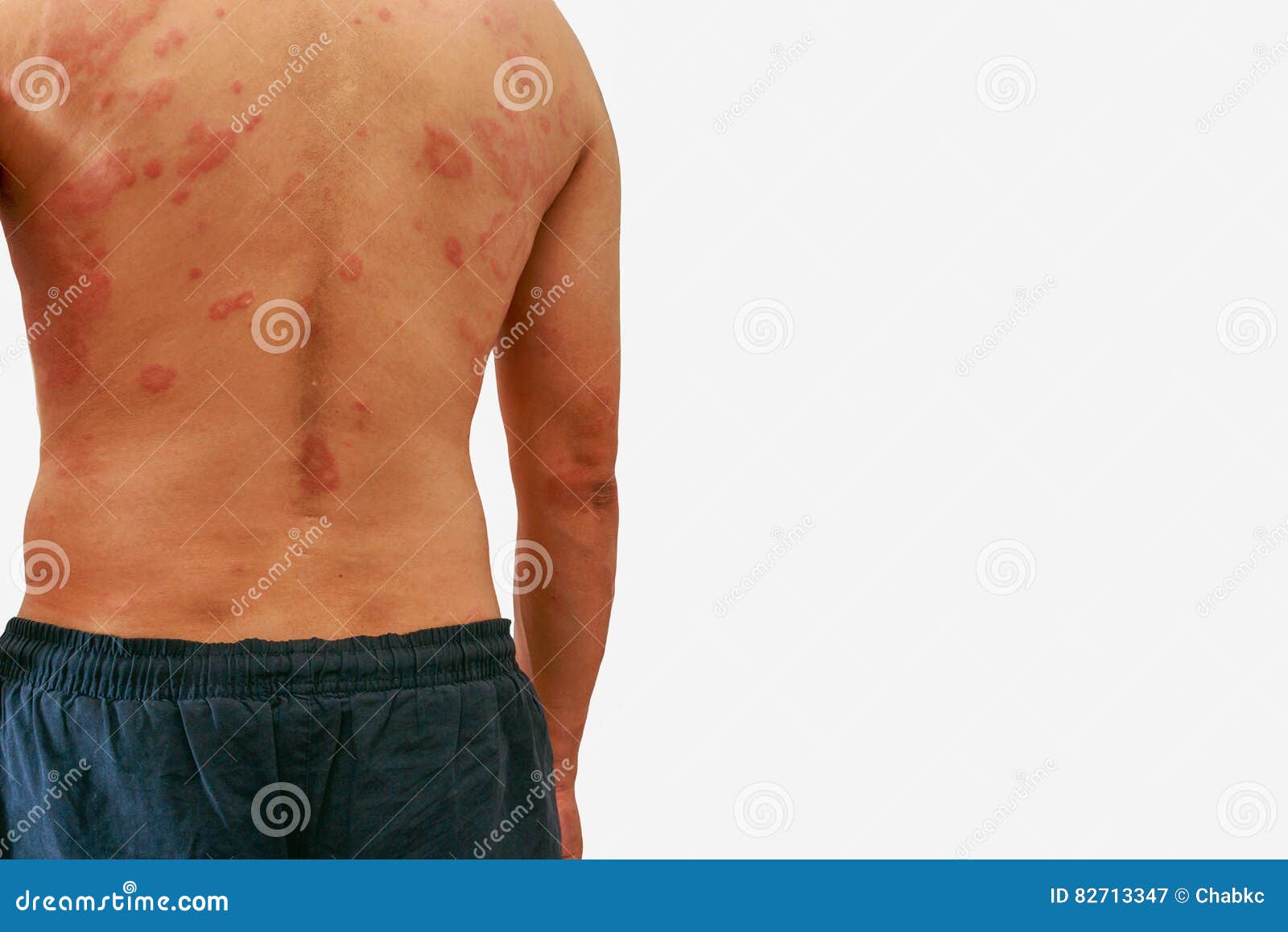 Dermatitis problem stock image. Image of rash, dose, food - 82713347