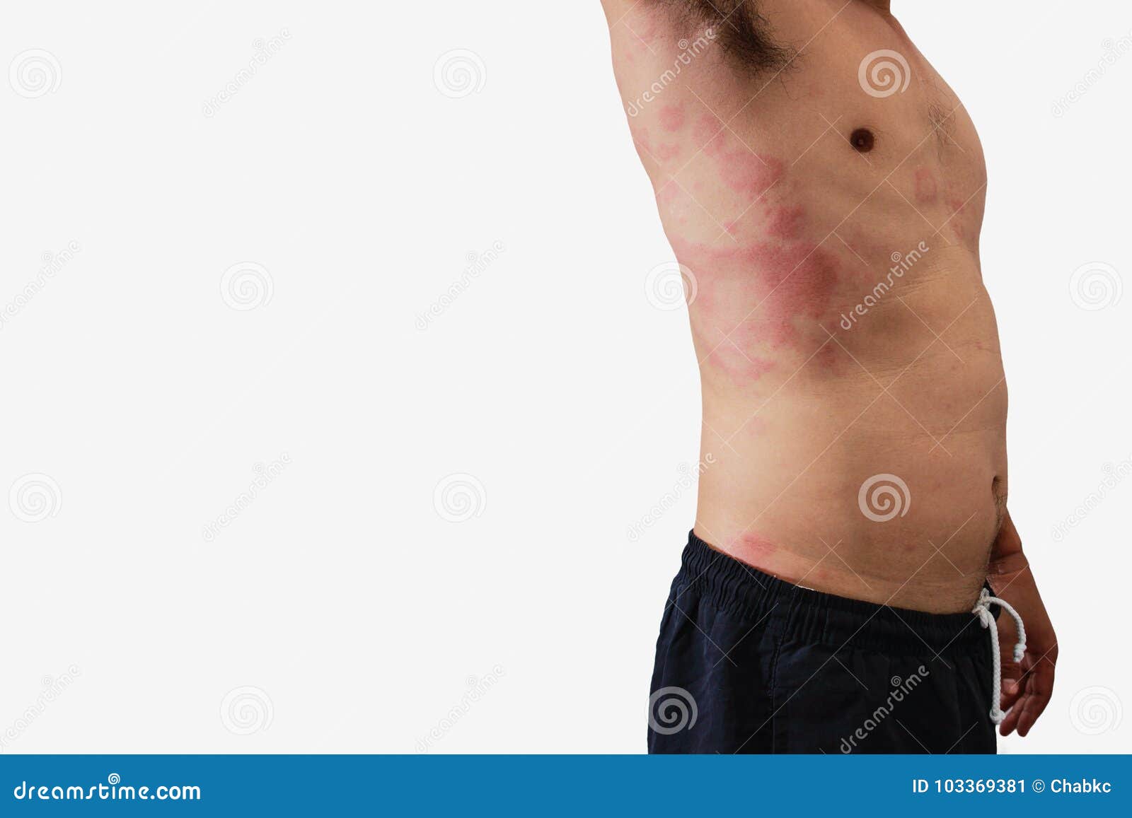 Dermatitis Problem of Rash ,Allergy Rash Stock Image - Image of sick ...
