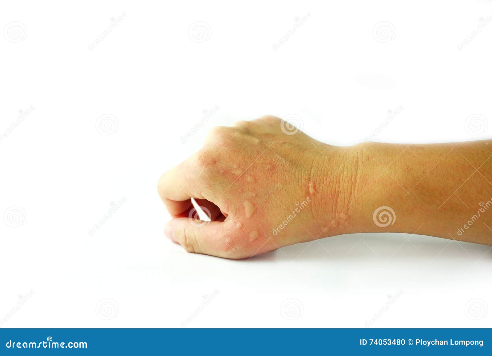 Rash Allergy From Touching Arms ,eczema, Dermatitis Royalty-Free Stock ...