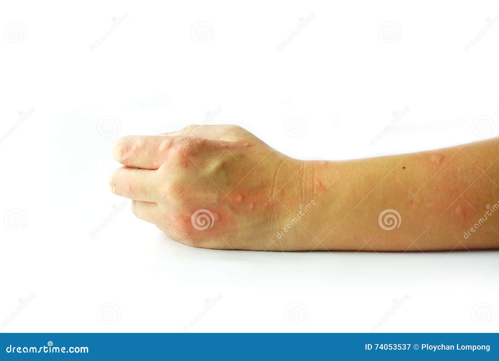 Eczema Arms