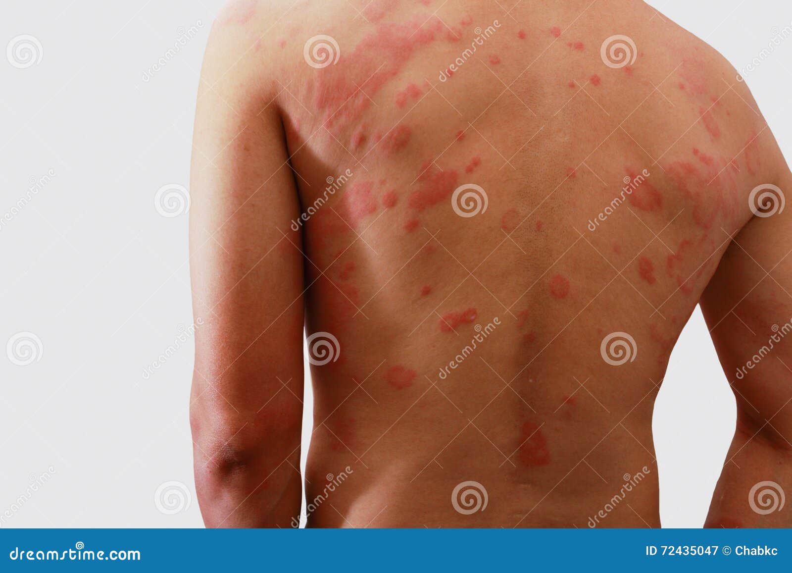 Dermatitis of Rash , Allergy Rash Stock Image - Image of healthcare ...