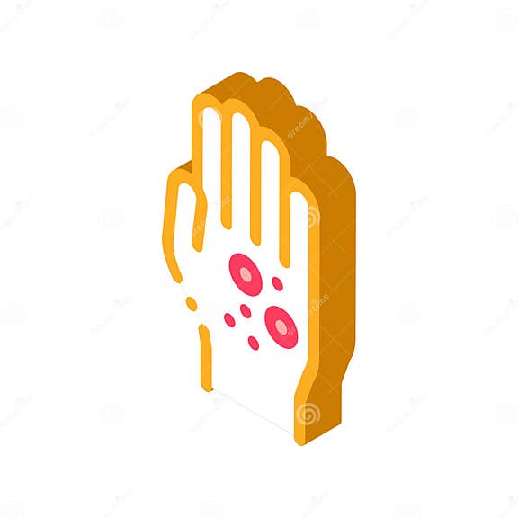 Dermatitis Rash On Hands Isometric Icon Vector Illustration Stock