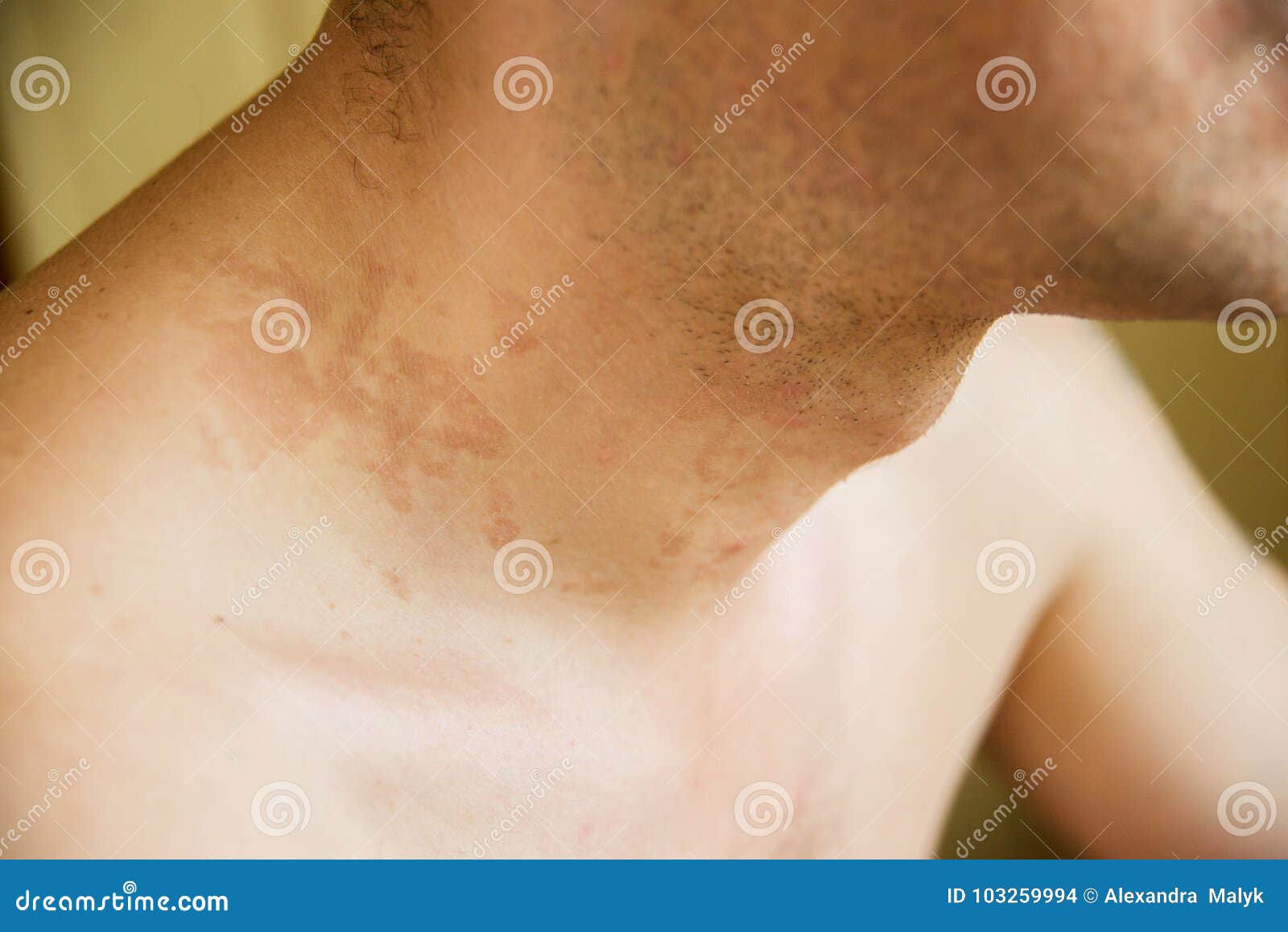 Dermatitis skin stock photo. Image of eczema, infection - 103259994