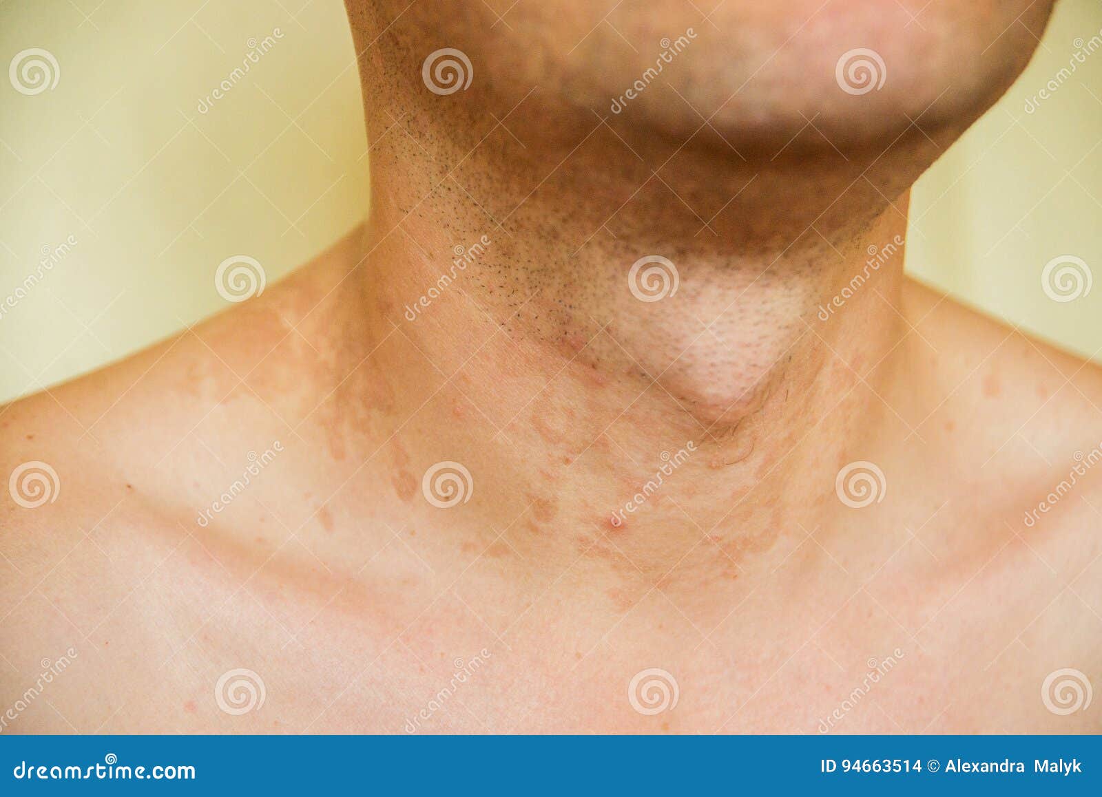 Skin Diseases On Neck