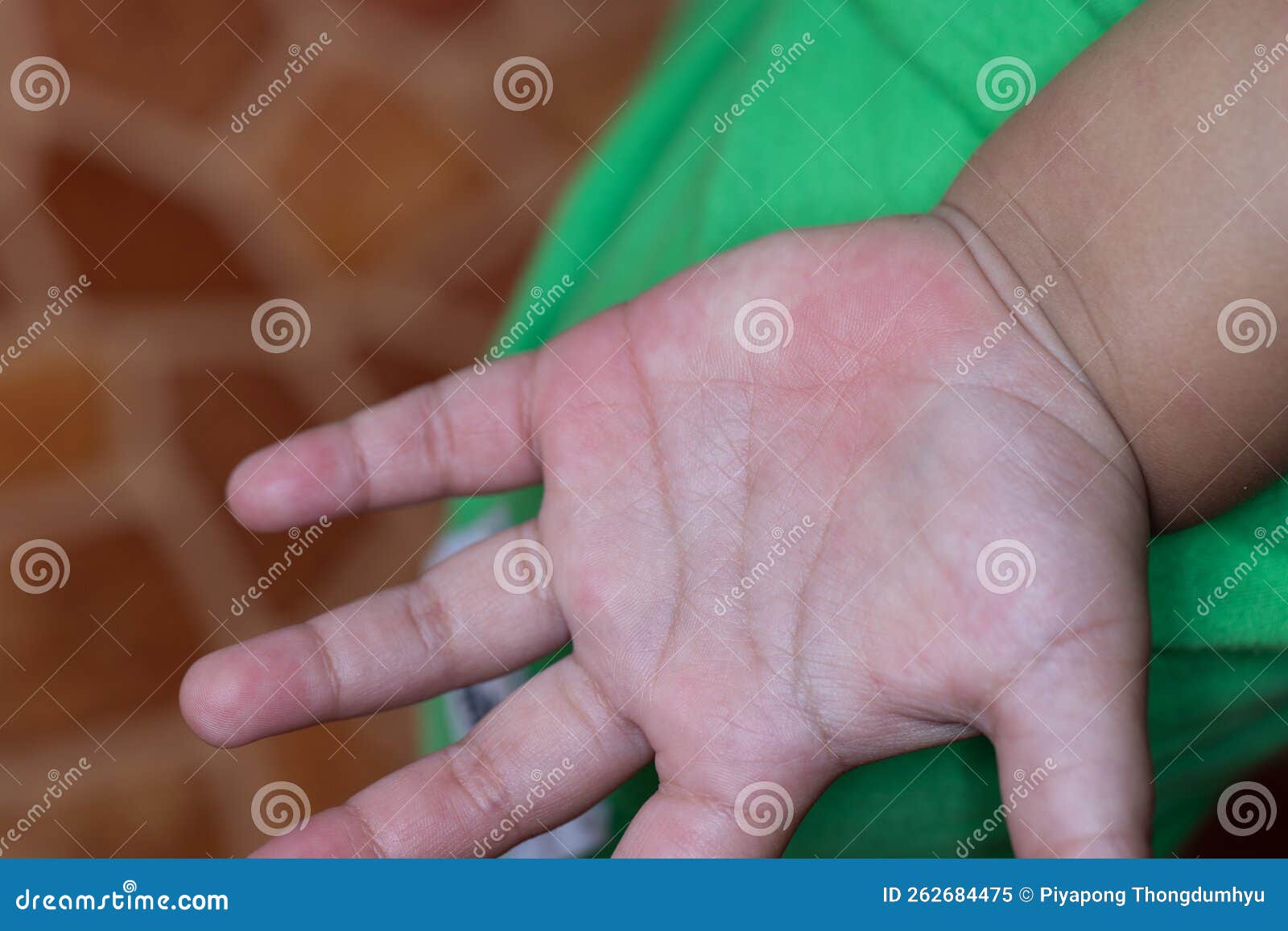 Dermatitis Small Warty Bumps Appear on the Skin in Child. Stock Image ...