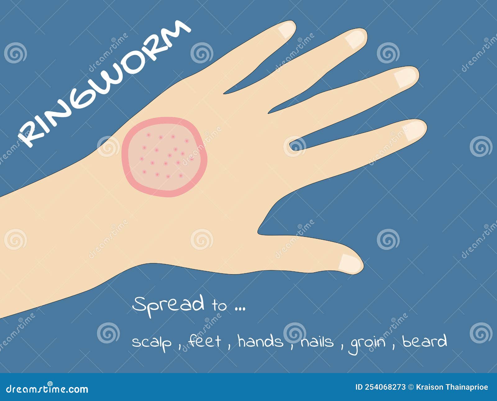 Dermatofytose of Ringworm is Schimmelinfectie Vector Illustratie ...