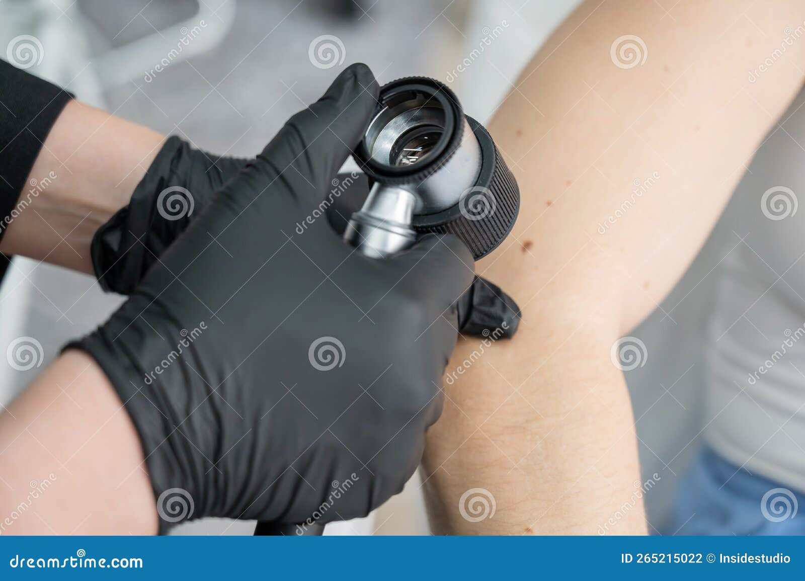 A Dermatologist Examines a Patient& X27;s Mole through a Dermatoscope ...