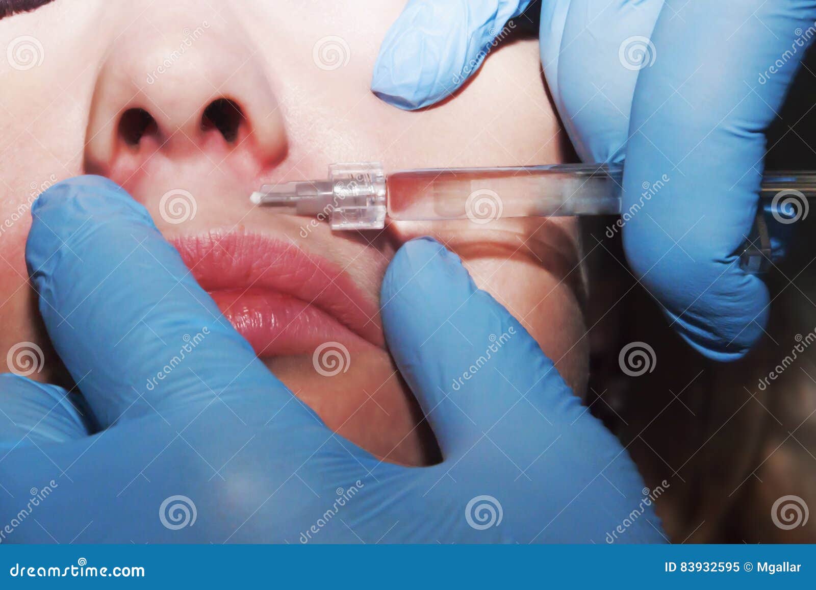 Dermatologist Performs Contour Plastic in the Lips with Filler Stock ...