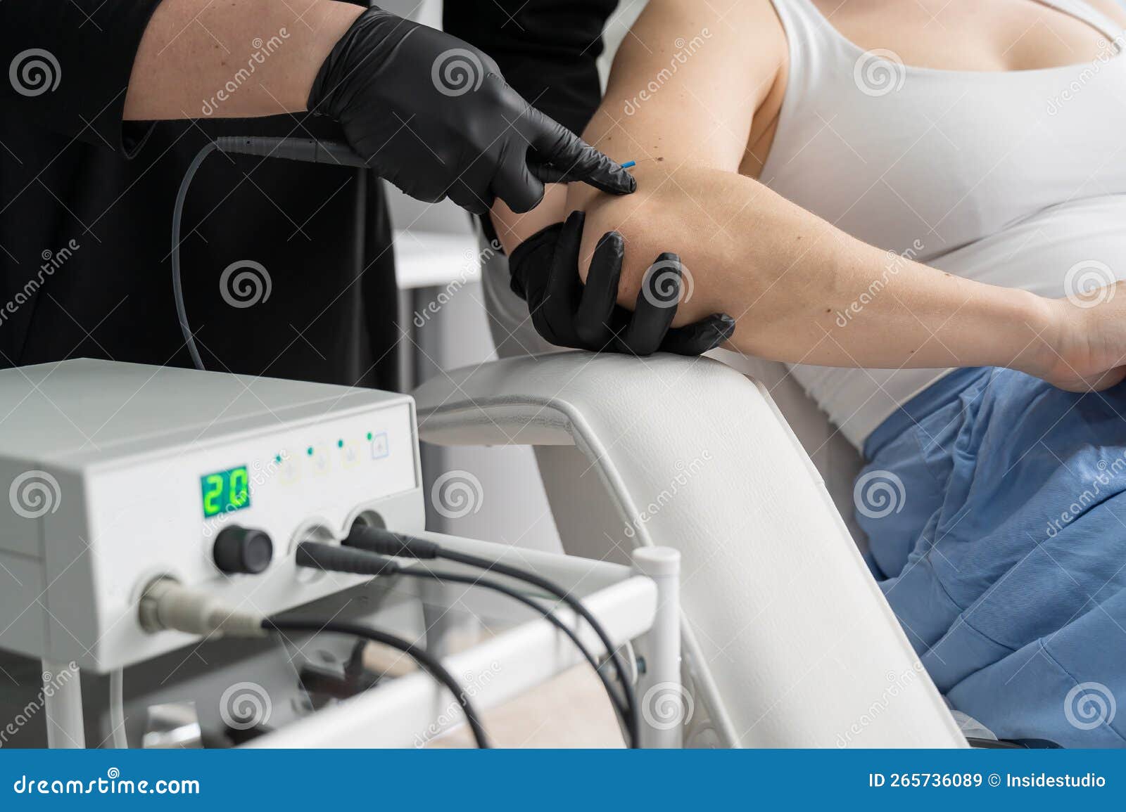 Dermatologist Removes a Mole on a Patient& X27;s Arm Using an ...