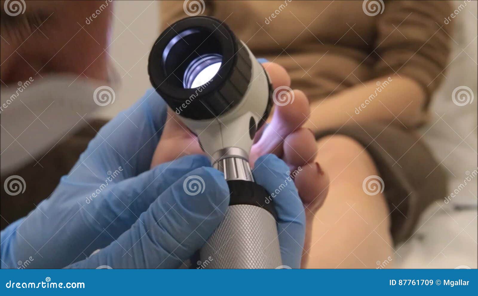 Dermatologist Surgeon Examines the Patient with the Plantar Wart Using ...